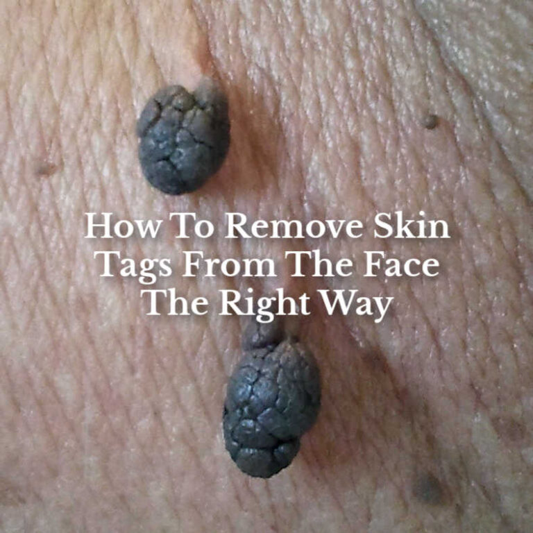 How to Remove Skin Tags on the Face Safely (Grooming Guide)